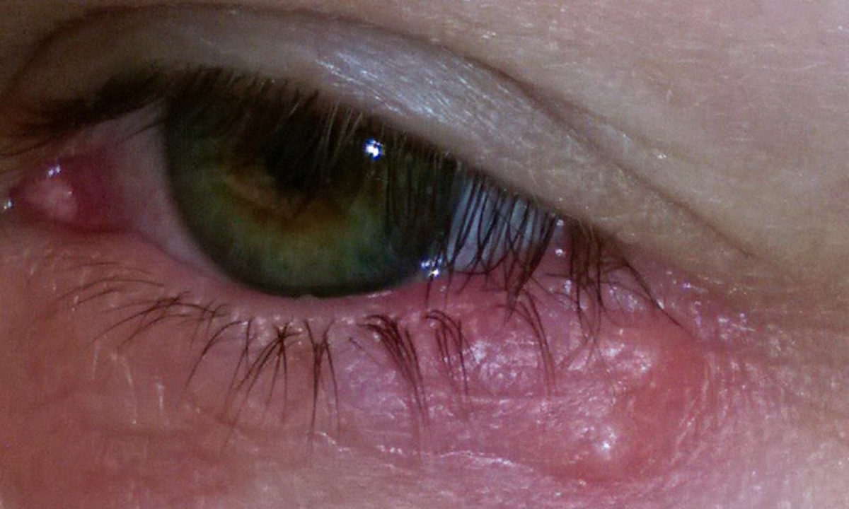 Herpes ocular: o que é, sintomas e tratamento - Dr. Luiz Formentin